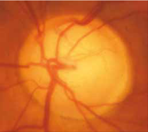 Näköhermon papillan tutkiminen