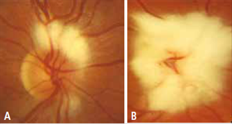 Näköhermon papillan tutkiminen