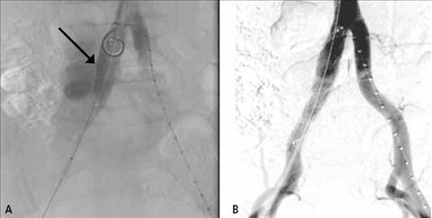 Selkäkipuisen miehen suurentunut maksa ja hengenahdistus
