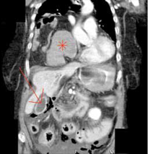 Kaasua vapaassa vatsaontelossa - syynä kaasua tuottavien bakteerien ...