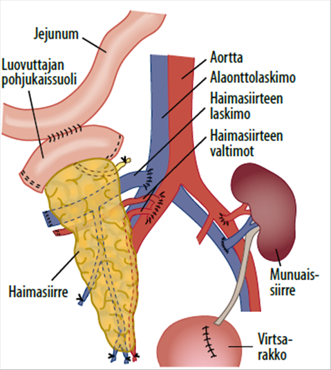 Tyypin 1 diabeetikolle siirrettiin samanaikaisesti haima ja munuainen
