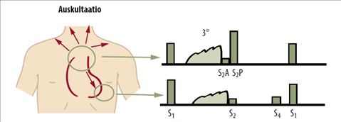 Aorttaläpän ahtauma