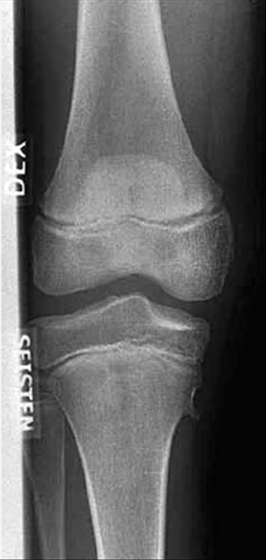 Nuoren jalkapalloilijan napsuva polvi