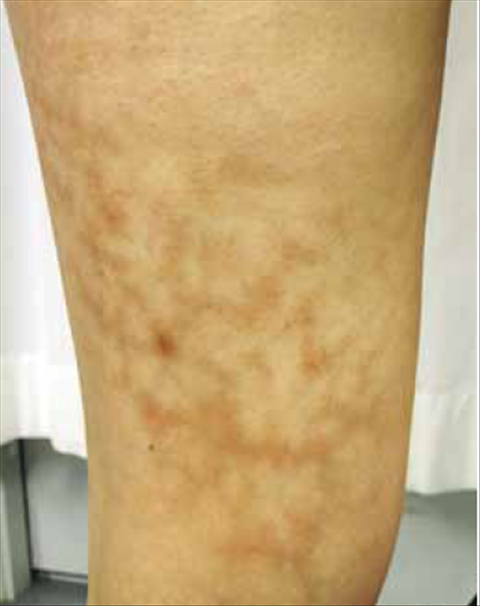 Kirjavaksi muuttunut iho